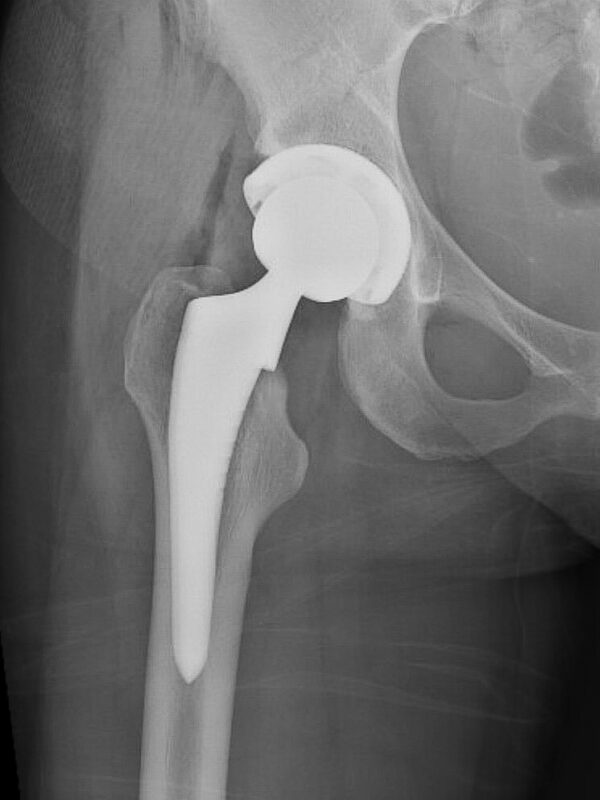 Hip Replacement Surgery at 36: Tips for Recovery
